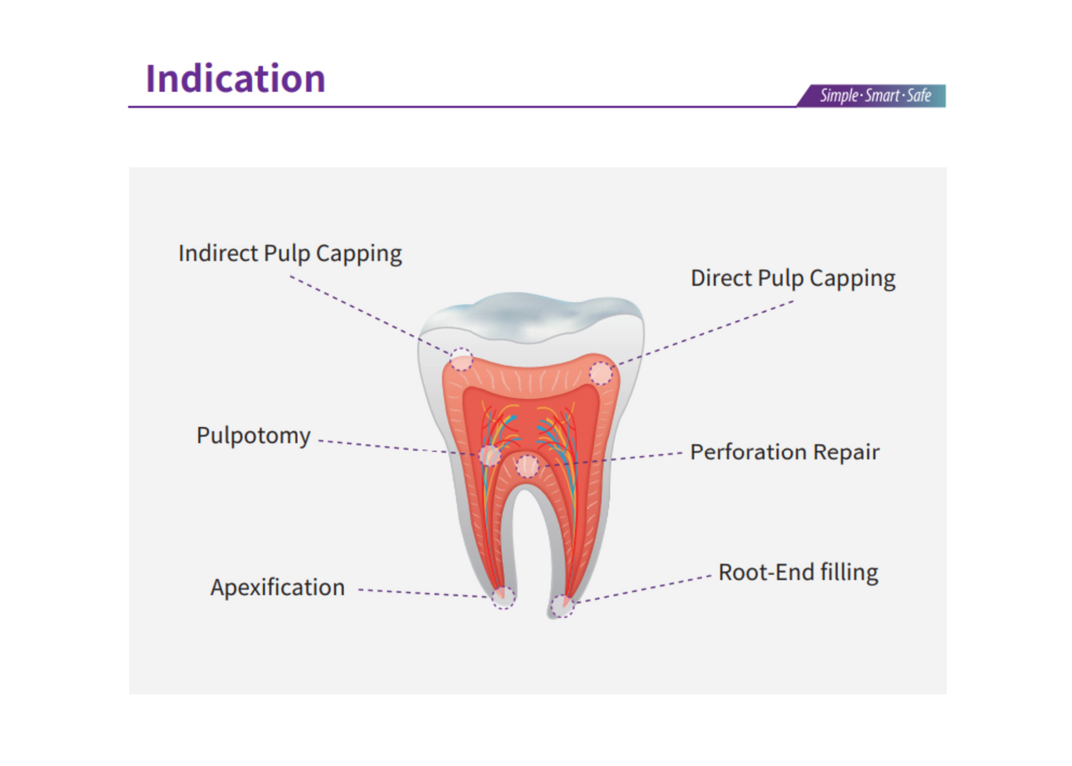 EndoCem PreMix MTA – OsseoDent™